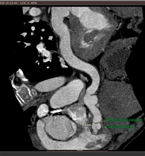 Six Month Follow Up Ct Angiography Download Scientific Diagram