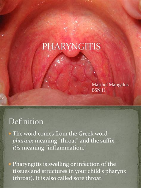 Pharyngitis Tonsilitis Pdf Medical Specialties Diseases And Disorders