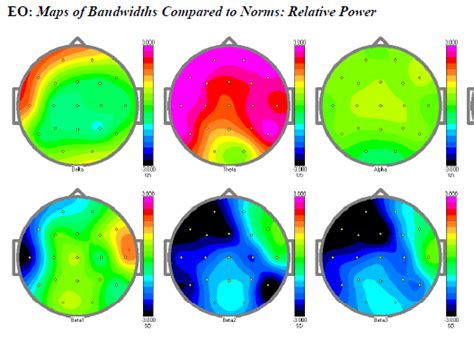 Neurofeedback Qeeg Brain Maps About Neurofeedback