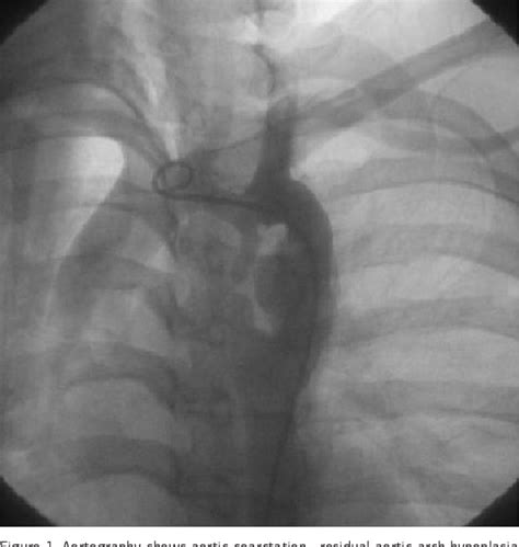 Figure 1 From Case Of A Ascending To Descending Aortic Bypass For
