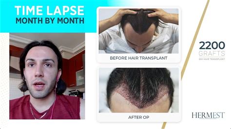 Dhi Hair Transplant Time Lapse In Turkey Before And After Hermest Hair