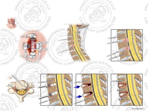 C3 5 Anterior Cervical Discectomy And Fusion With Peek Cage No Text