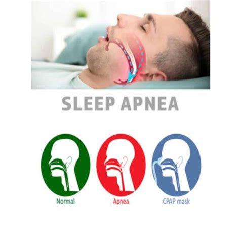 How To Cure Sleep Apnea Naturally At Home Without Cpap Healthsoothe