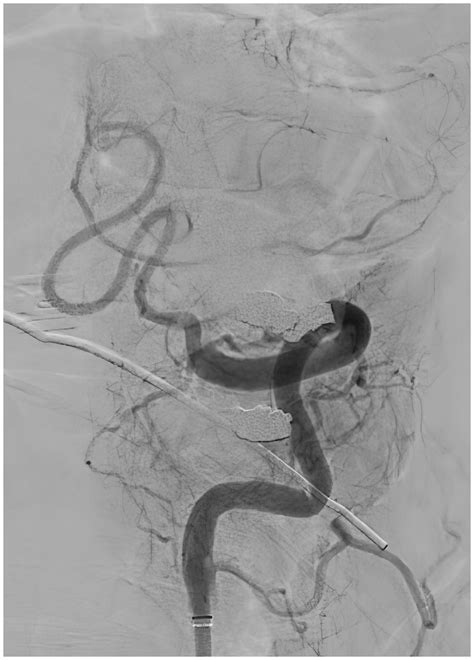 Frontiers Rescue Therapy After Thrombectomy For Large Vessel