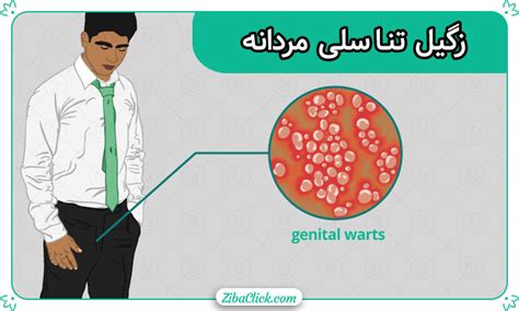 زگیل تناسلی مردان علل، علائم و راه پیشگیری از آن زیبا کلیک