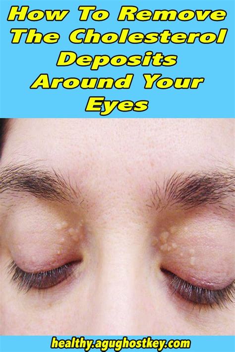 Cholesterol Deposits Around The Eyes Causes And Natural Remedies
