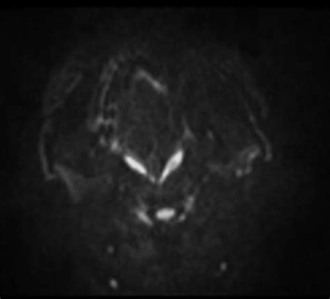 Diffusion Weighted Mri Dwi Mri Sequence Physics And Image Appearance