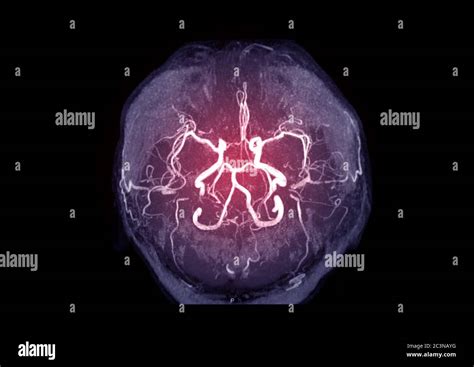 Angiograma De Accidente Cerebrovascular Fotografías E Imágenes De Alta