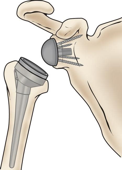 Reverse Shoulder Replacement Dr Mukhis Raj Hospital
