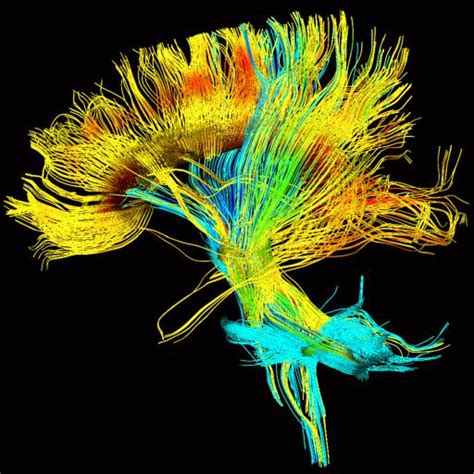Dti Tractography Siemens Healthineers Ecuador