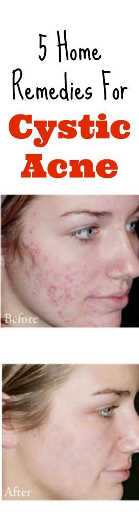 5 Home Remedies For Cystic Acne