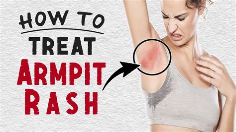 How To Treat Armpit Rash At Home Home Remedies For Armpit Rash