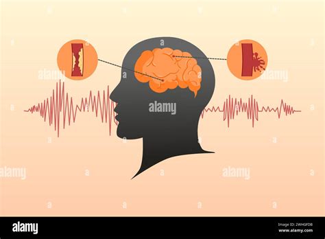 Stroke Disease Concept Ischemic And Hemorrhagic Scientific Medical