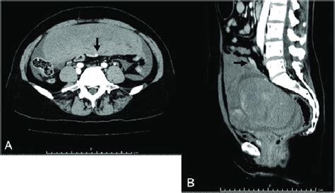 Abdominal Contrast Enhanced Computed Tomography Ct Image A