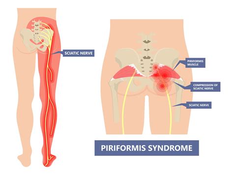 Piriformis Syndrome Physioflow Pt Physical Therapy Vancouver Wa