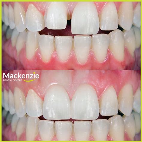 Woodbridge Dental Veneers Mackenzie Dental Centre