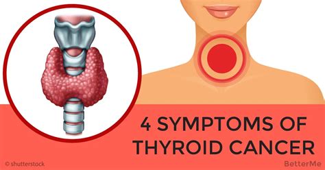 Thyroid Cancer Signs And Symptoms And Treatment Treatment Of