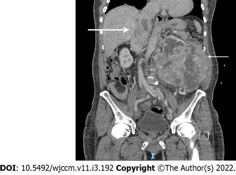 Computerized Tomography Scan Of Abdomen And Pelvis Showing Left Renal