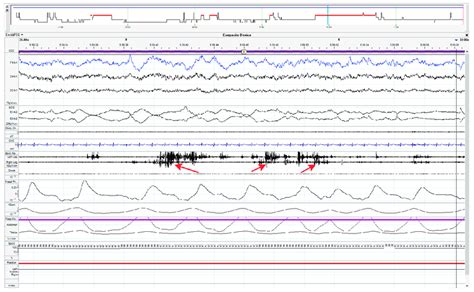 Polysomnography Of Patient With Rem Sleep Behavior Disorder Rbd 30 S