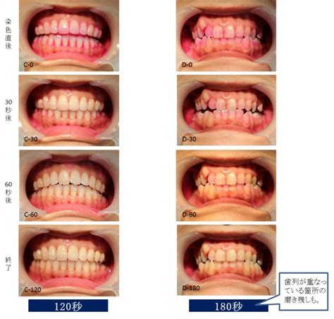 6 4～10は「歯と口の健康週間」＞歯磨きの磨き残しに関する実験 歯並びが悪いと、3分磨いても歯垢は落とし切れないという結果に