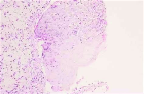 Predominantly Neutrophilic Inflammatory Infiltrate With Hydropic