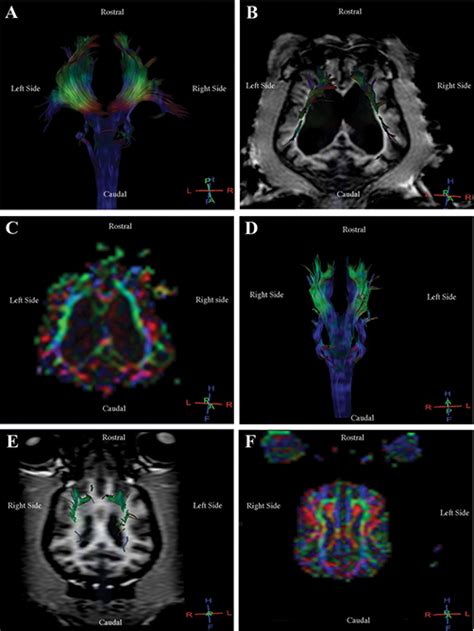 Diffusion Tensor Tractography In Cerebral White Matter Intechopen