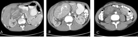 Contrast Enhanced Computerized Tomography Scan Shows Distinctive