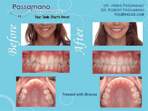 Lots Of Crowding In Phase 1 To Extractions To Phase 2 Braces To