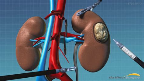 Robotic Davinci Partial Nephrectomy Youtube