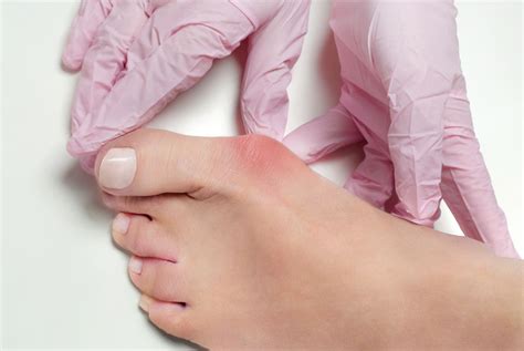 Juanetes O Hallux Valgus