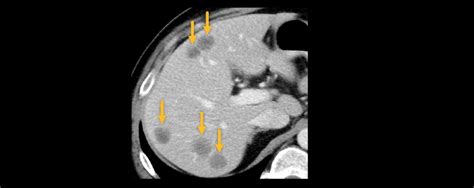 Abdominal Ct Liver • Litfl • Radiology Library