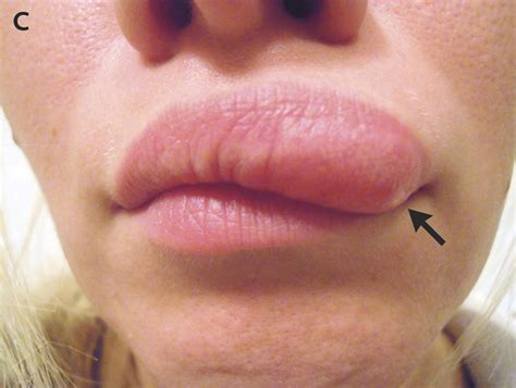 Why Have I Got Lumps On My Lips