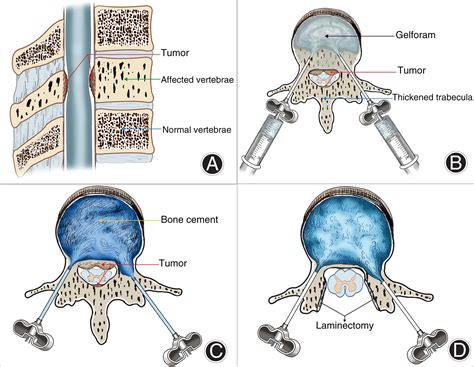 Thoracic Vertebral Hemangioma With Spinal Cord Compression