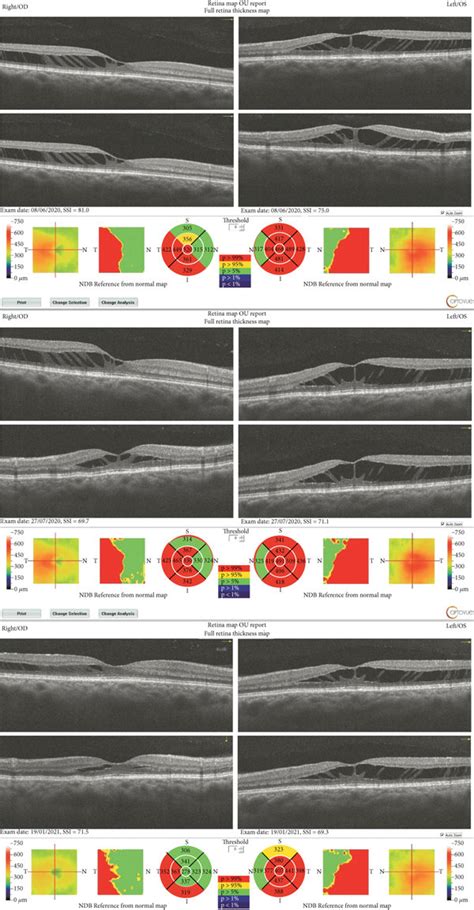 Bilateral Oct Imaging Preoperative 1 Day Postoperative And 6 Months