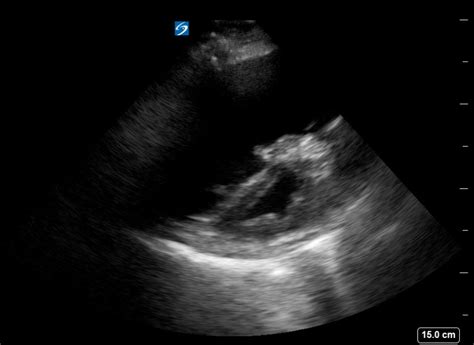 Right Heart Strain Emory School Of Medicine