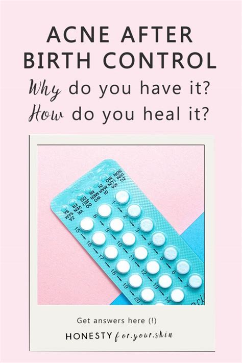 Acne After Stopping Birth Control Help Why Do I Have It What Can I Do