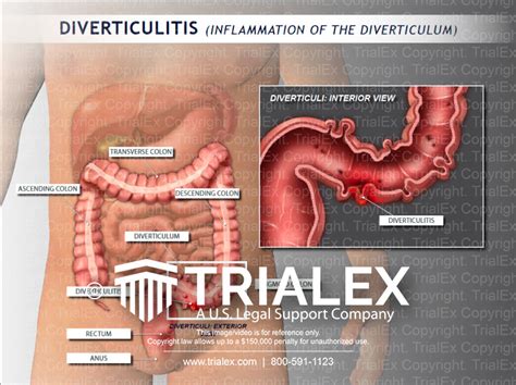 Anatomy Of Sigmoid Colon Showing Diverticulitis Trial Exhibits