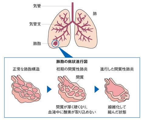 日常生活のアドバイス：間質性肺炎 Vol 15 ｜サワイオンコロジー｜沢井製薬