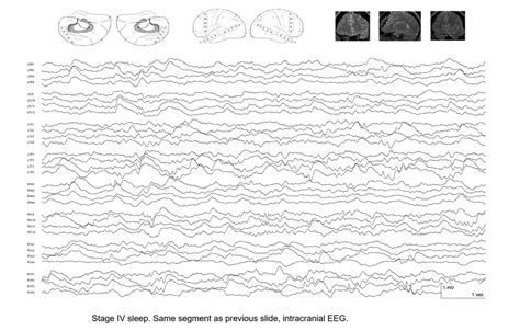 Fig3 Deep Slow Wave N3 Sleep Intracranial Eeg Same Segment As Fig2