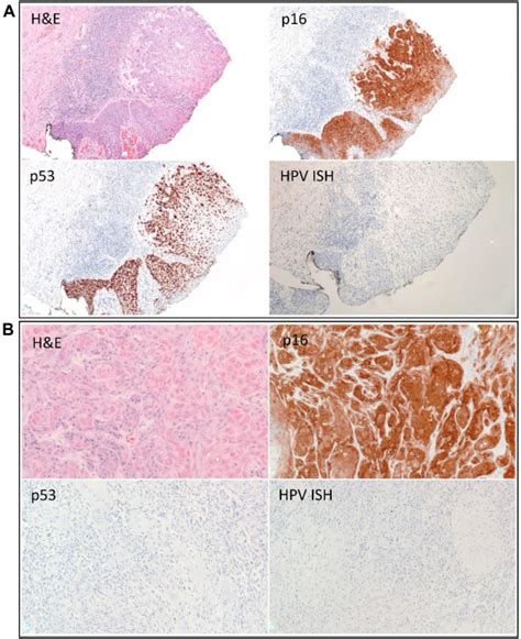 Classification Of Vulvar Squamous Cell Carcinoma And Precursor Lesions
