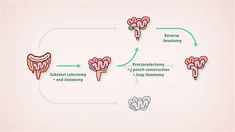Patient Teaching Surgical Treatment For Ulcerative Colitis Tvasurg
