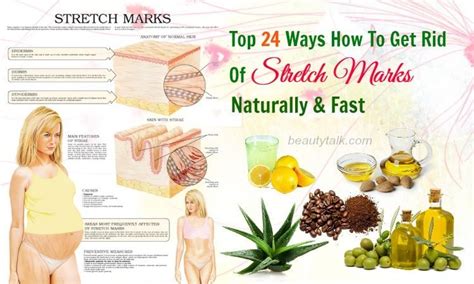 Top 24 Ways How To Get Rid Of Stretch Marks Naturally And Fast