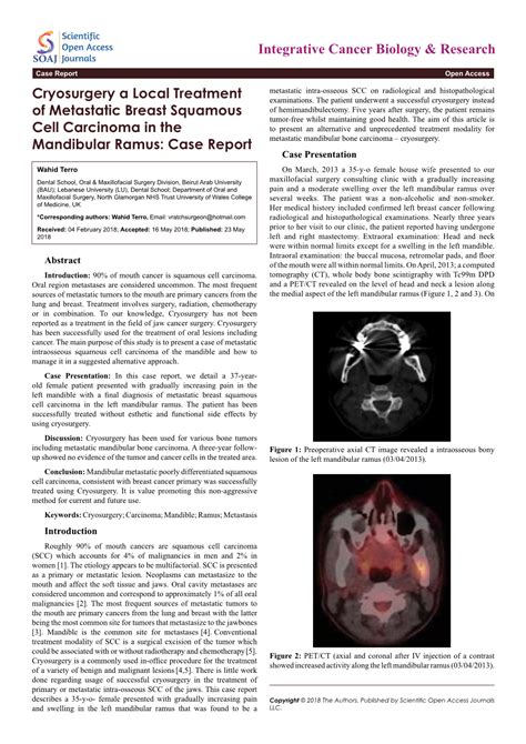 Cryosurgery A Local Treatment Of Metastatic Breast Squamous Cell