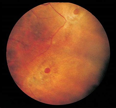 Lattice Degeneration Cystic Retinal Tufts Asymptomatic Retinal Breaks