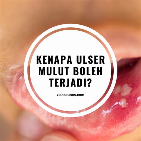 Punca Dan Cara Atasi Ulser Mulut