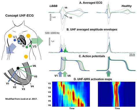 Jcdd Free Full Text Ultra High Frequency Ecg In Cardiac Pacing And