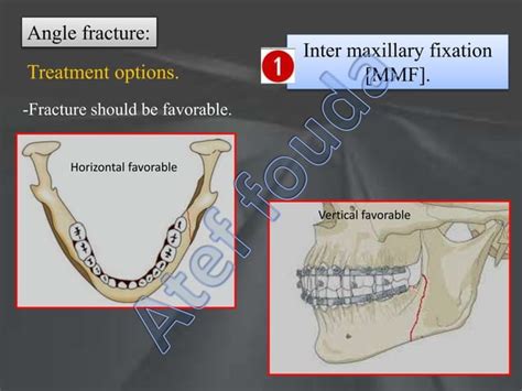 Fracture Mandibular Angle
