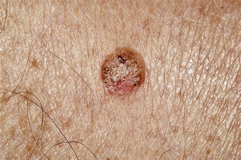 Seborrheic Keratosis Stock Image C028 6663 Science Photo Library