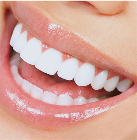 The Ultimate Guide To Dental Veneers Realspacetours