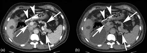 Dual Energy Computed Tomography Dect Imaging With Conventional